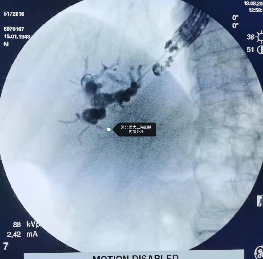 分享一例EUS-BD（9）之AS+HJS